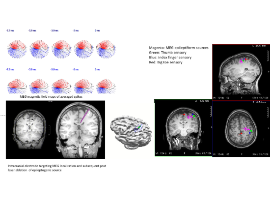 New MEG at UAB to enhance neuroimaging possibilities for treatment of ...