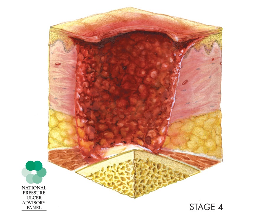 Pressure Ulcer - Stages - Primary Care Provider Resource for Spinal ...
