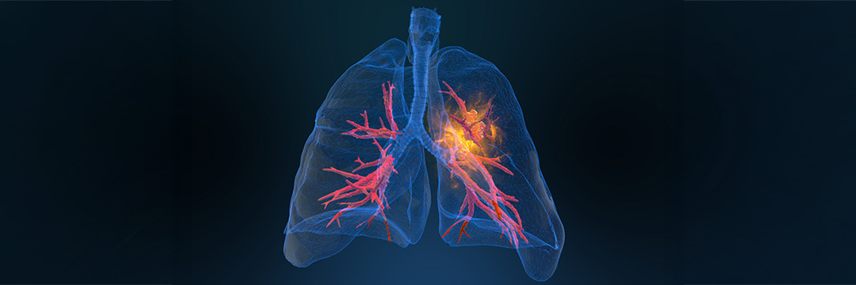 UAB Lung Cancer Update - Pulmonary, Allergy and Critical Care Medicine