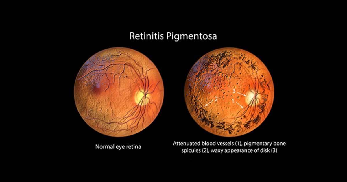 ALG6 acts as a modifier gene in the inherited genetic eye disease ...